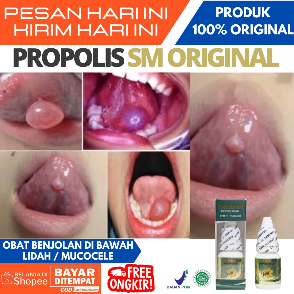 Jual Obat Benjolan di Bawah Lidah, Bibir / Penghilang Benjolan di Bawah ... Jual Obat Benjolan di Bawah Lidah, Bibir / Penghilang Benjolan di Bawah ...