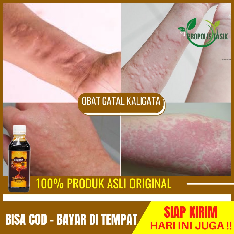 Jual Obat Gatal Kaligata, Menghilangkan Biduran Kronis, Obat Biduran ...
