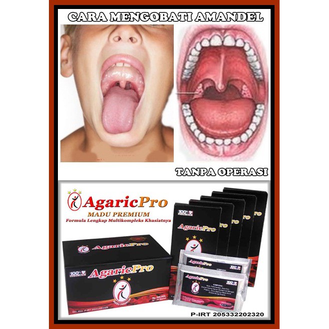 Jual OBAT HERBAL RADANG AMANDEL UNTUK ANAK DAN DEWASA AMPUH AMAN TANPA OPERASI | Shopee Indonesia