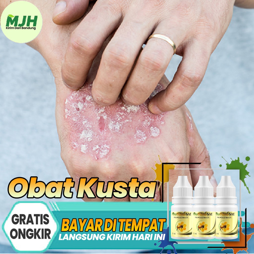 Jual Obat Kusta Lepra Atau Hansen Obati Kerusakan Saraf dan Mati Rasa ...
