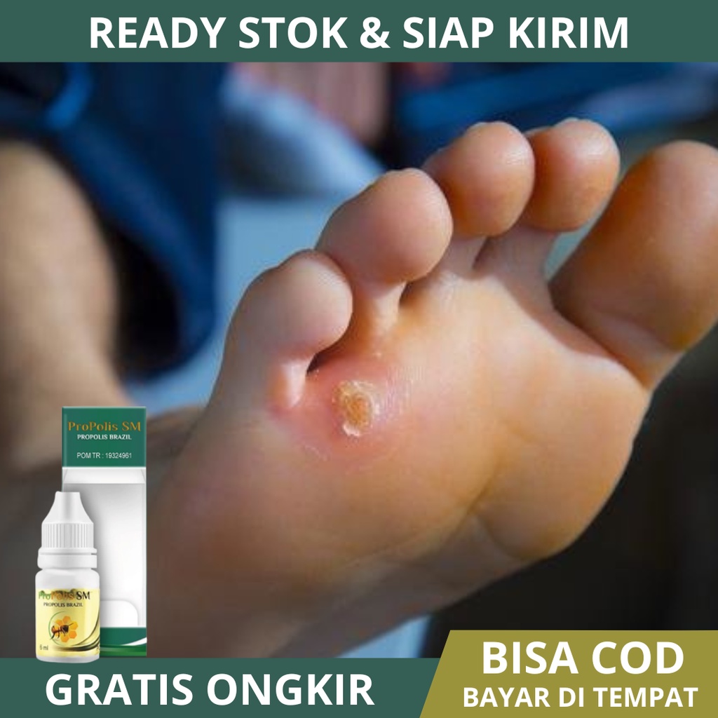 Jual Obat Mata Ikan, Obat Mata Ikan Di Kaki Dan Tangan, Obat Mata Ikan ...