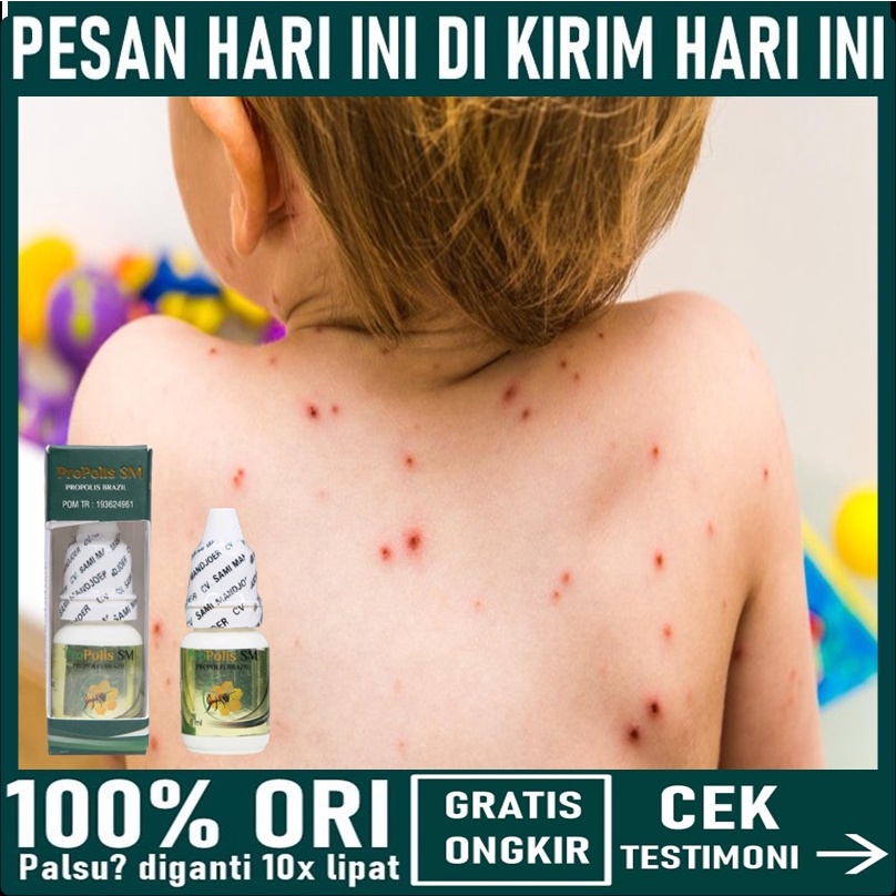 Jual Salep cacar api / ular - Obat Campak Anak dan Dewasa - Obat herpes ...