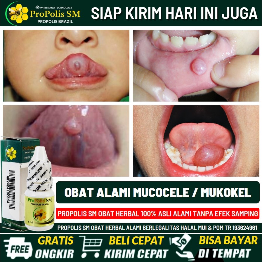 Jual Obat Mukokel 100% Alami Untuk Anak & Dewasa, Obat Mucocele, Salep ...