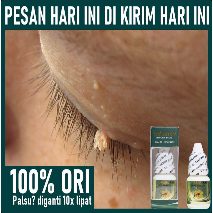Jual Obat Kutil di Kelopak Mata - Obat Penghilang Kutil di Kelopak Mata ...