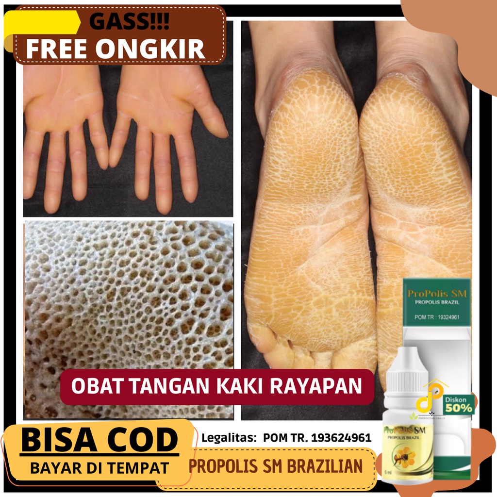 Jual Obat Telapak Kaki Berlubang kecil, Obat Trypobia, Obat Tryphobia ...