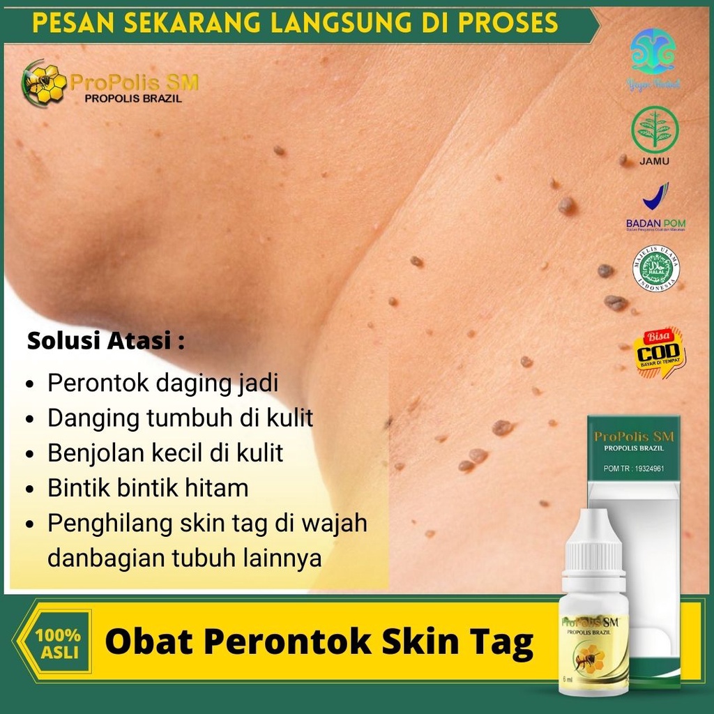 Jual Obat Perontok Daging tumbuh di kulit Benjolan kecil bintik hitam ...