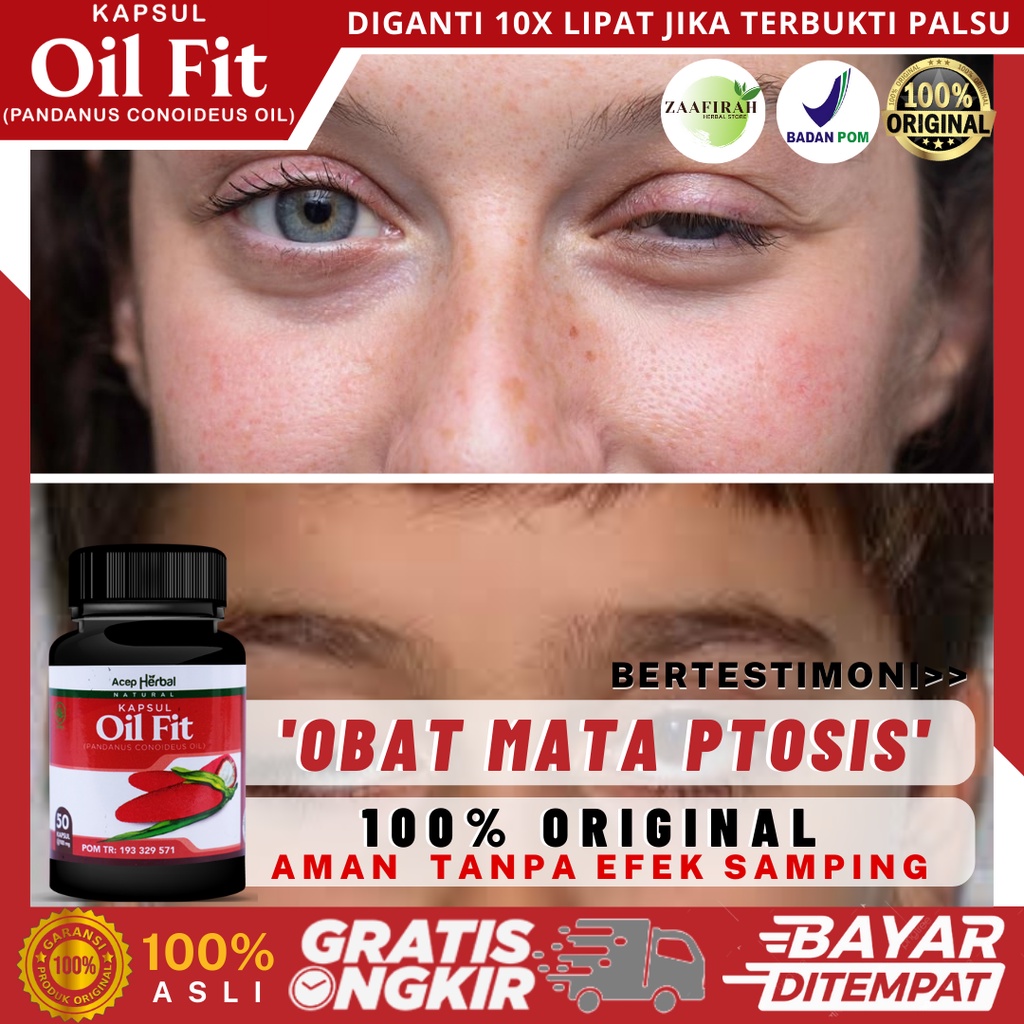 Jual Obat Kelopak Mata Turun Sebelah - Mata Ptosis - Mata Beda Sebelah ...