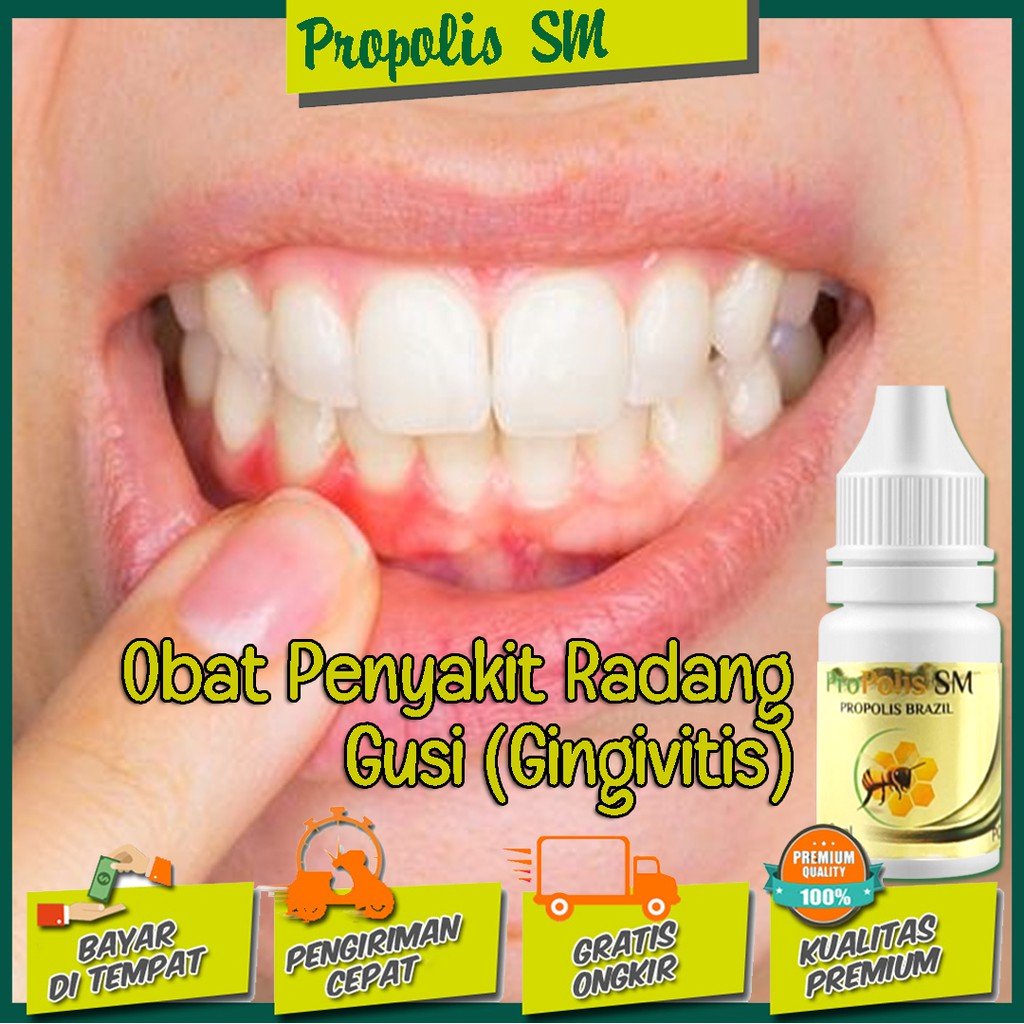 Jual Obat Penyakit Radang Gusi (Gingivitis) Herbal Propolis SM Terlaris | Shopee Indonesia