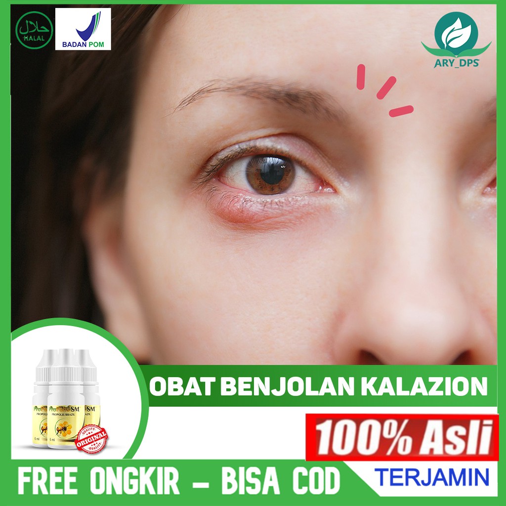 Jual Obat Benjolan Kelopak Mata - Kalazion - Kelopak Mata Bengkak ...