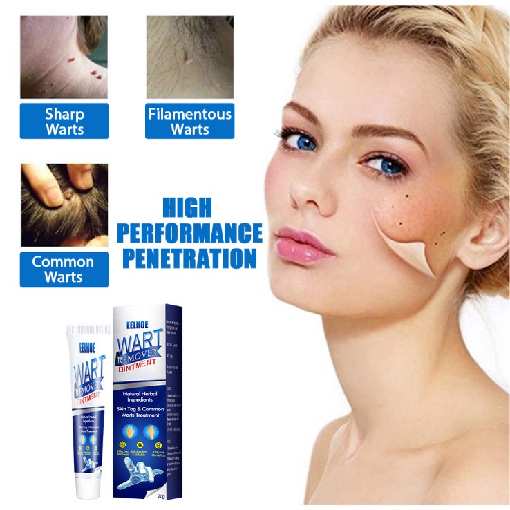 Jual OBAT PENGHILANG TAHI LALAT Skin Tag Remover Menghilangkan Kutil ...