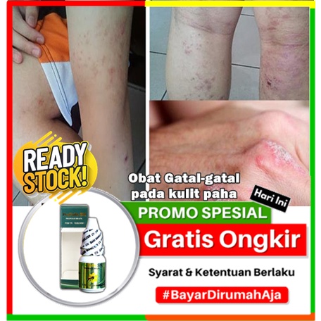 Jual Obat Gatal-gatal pada kulit paha, Obat Oles Penghilang Gatel-gatel ...