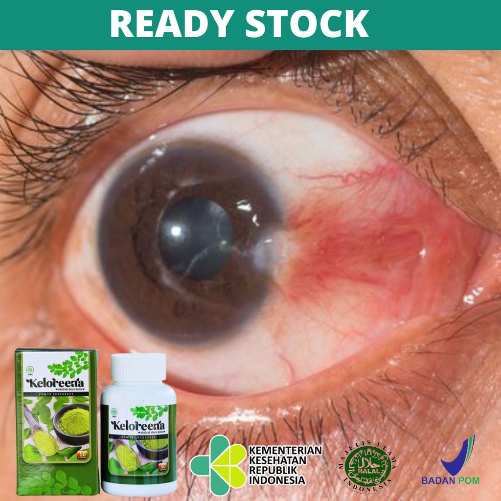 Jual Obat Mata Berlemak, Obat Penyakit Mata Pterygium, Obat Penghilang ...