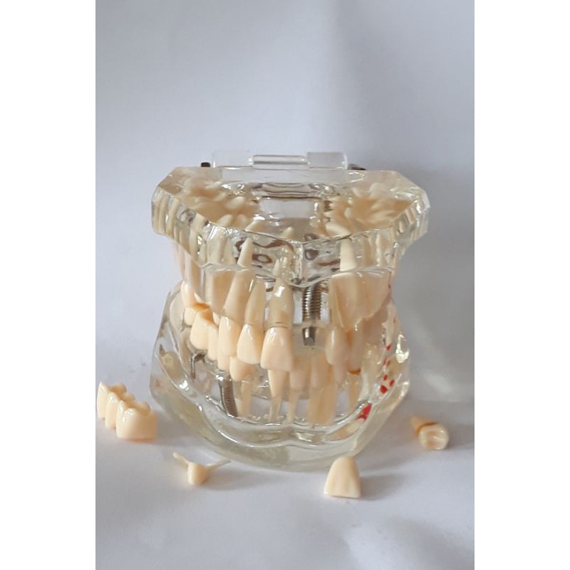 Jual Dental Study Model/ Phantom Gigi Transparan Restorasi dan Implant ...