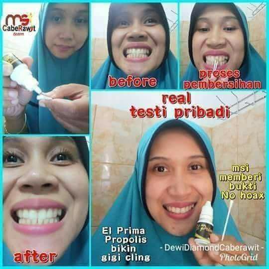 Jual Obat Perontok Karang Gigi Propolis Elprima Ganti Kemasan jadi ...