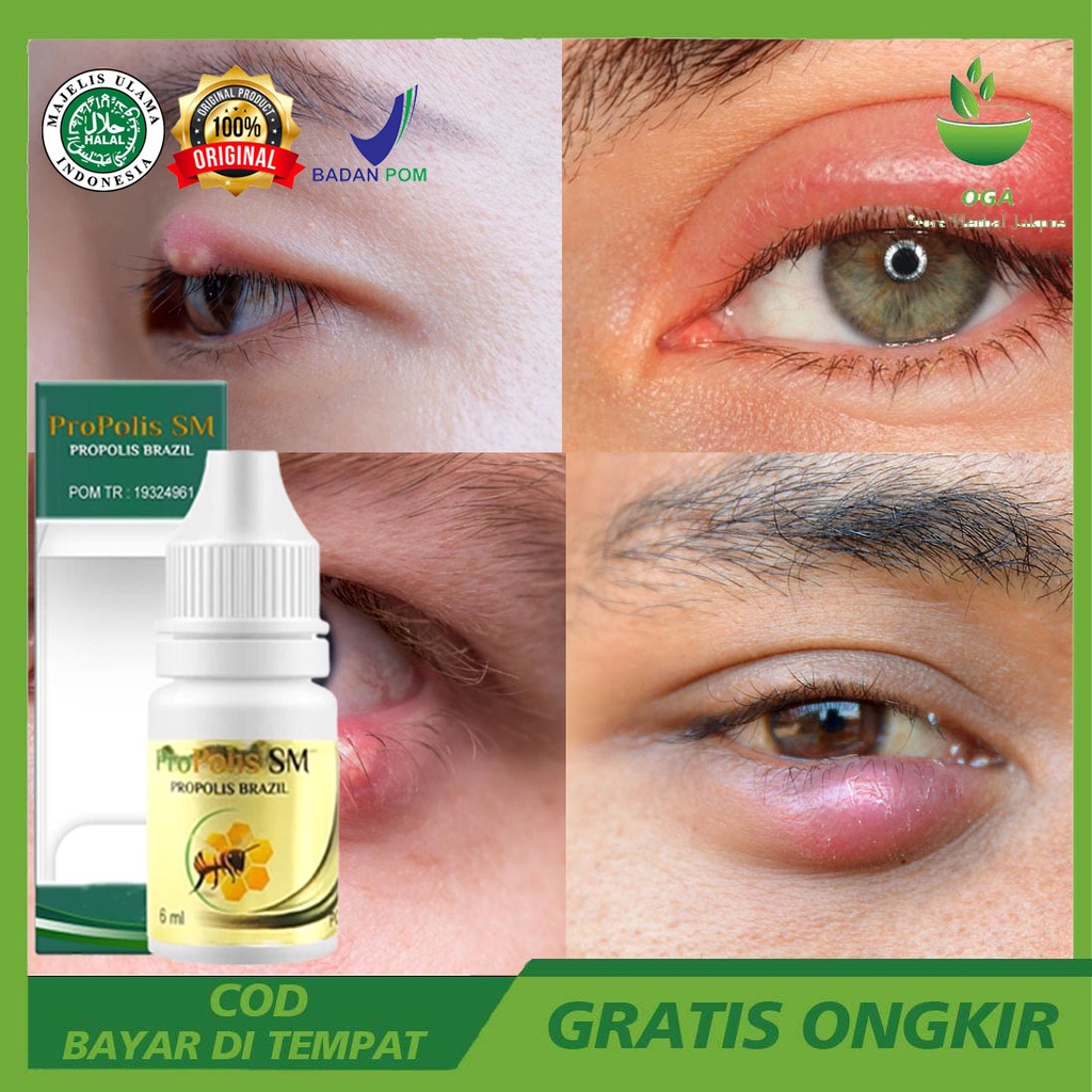 Jual Obat Bintitan Mata Bisa Untuk Anak Dan Dewasa Cepat Sembuh ...