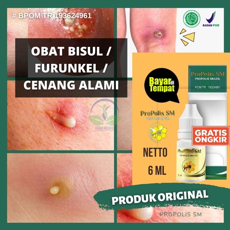 Jual Salep Untuk Bisul Ketiak, Obat Salep Buat Bisul Di Ketiak ...