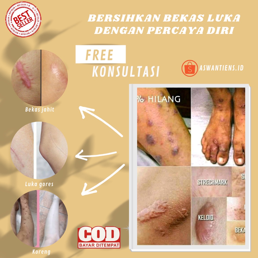 Jual PERAWATAN KESEHATAN PENGHILANG BEKAS LUKA KORENG KELOID SCARD ...