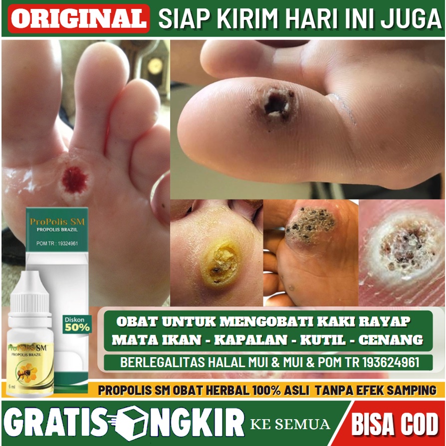 Jual Obat Mata Ikan di Telapak Kaki, Penghilang Mata ikan di Telapak ...