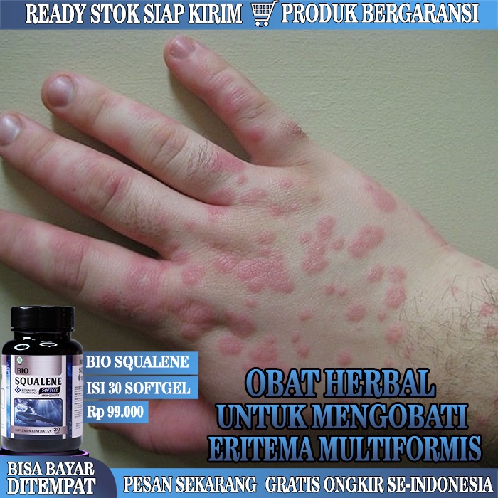 Jual Obat Eritema Multiformis, Infeksi Kulit Karena Virus/Balteri ...