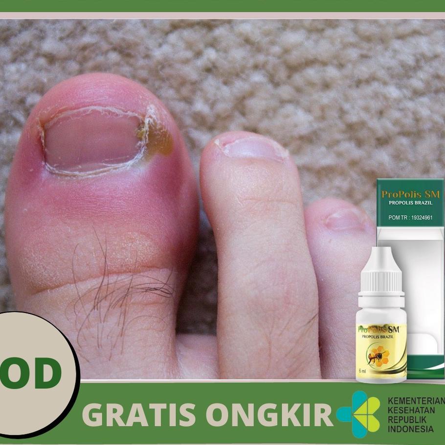 Jual Baru - Obat cantengan di kaki, Obat Cantengan kuku kaki dan tangan ...