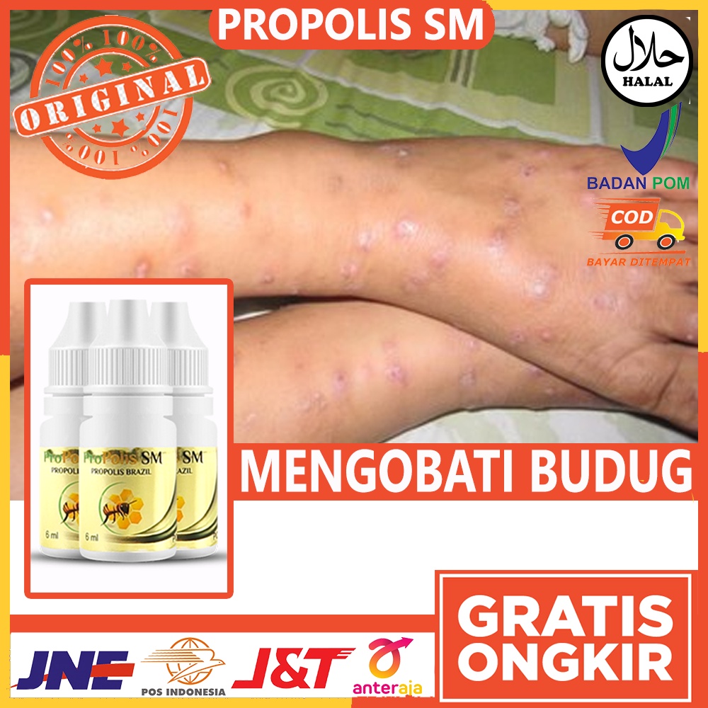 Jual Obat Budug - Obat Budug di Kaki - Obat Budug Santri - Obat Infeksi ...