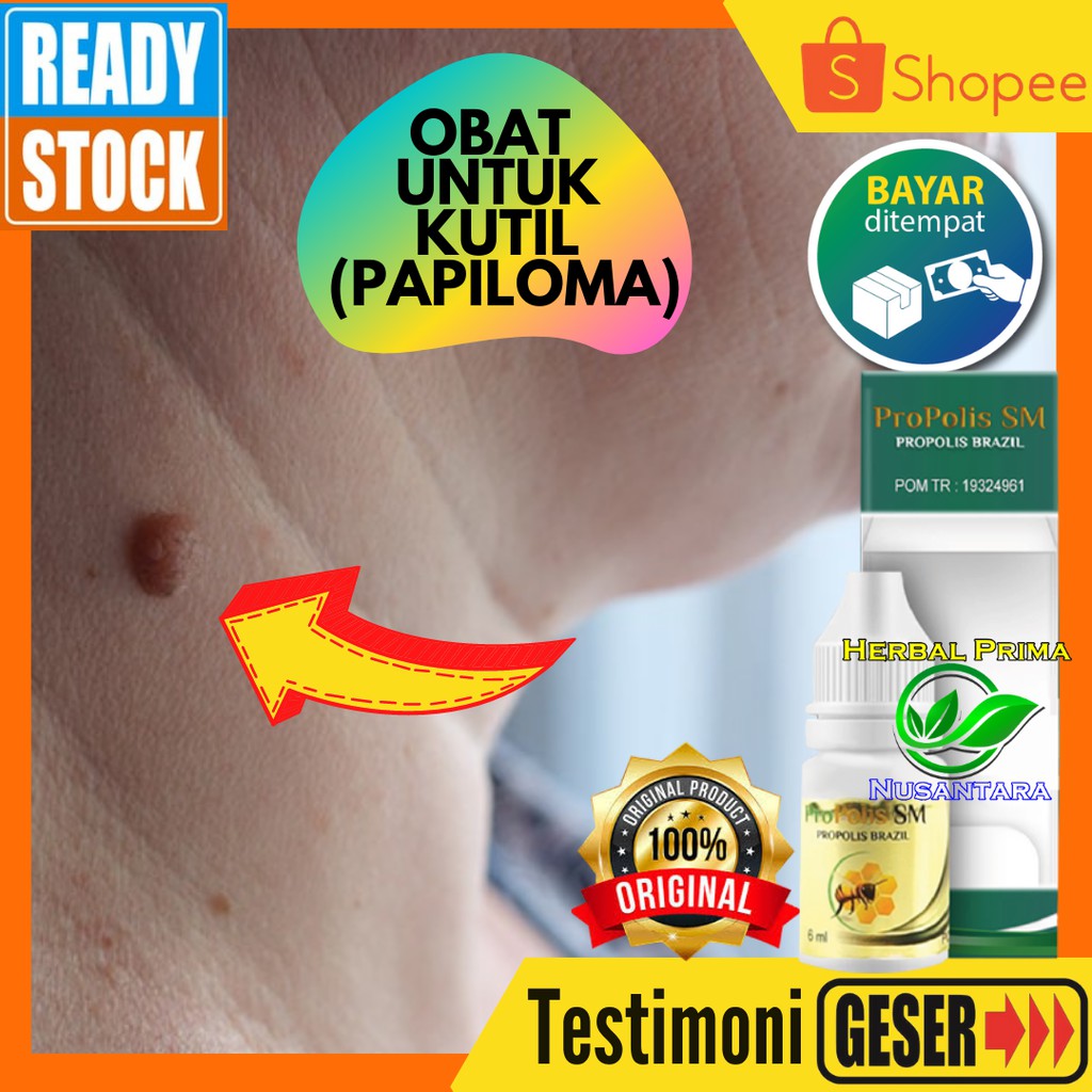 Jual Obat Tetes Oles Kutil di Leher Papiloma, Obat Kutil Oles, Skin Tag ...