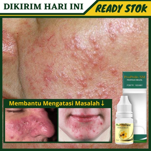 Jual Obat Penyakit Kulit Wajah (Rosacea) - Peradangan Pada Wajah, Ruam ...