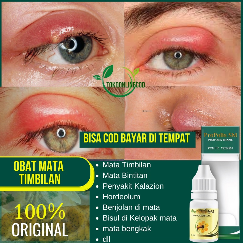 Jual Obat Mata Timbilan, Bintitan, Stye, Benjolan di Kelopak Mata ...
