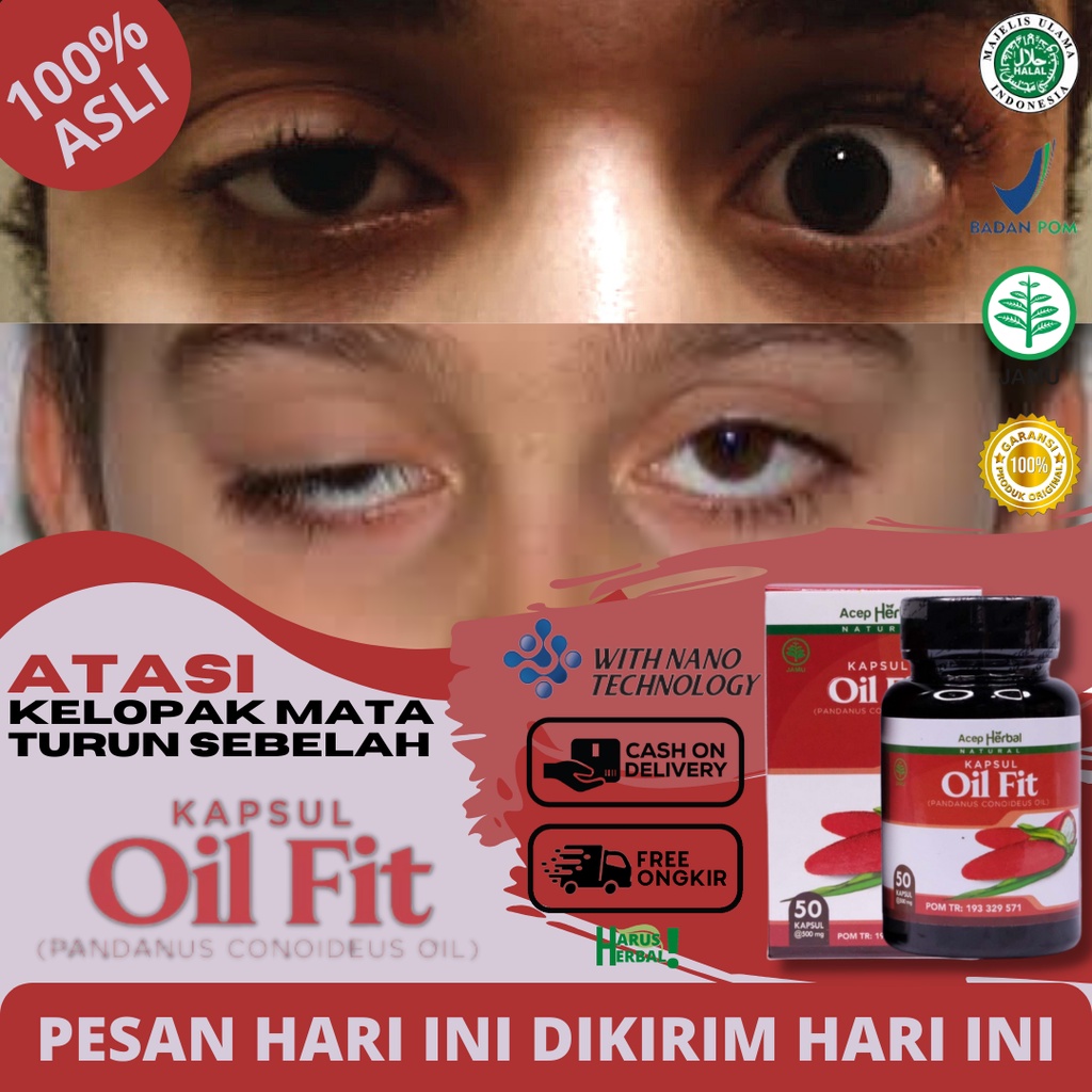 Jual Obat Kelopak Mata Turun Sebelah, Penyakit Mata Ptosis, Obat Mata Sipit Sebelah, Obat ...