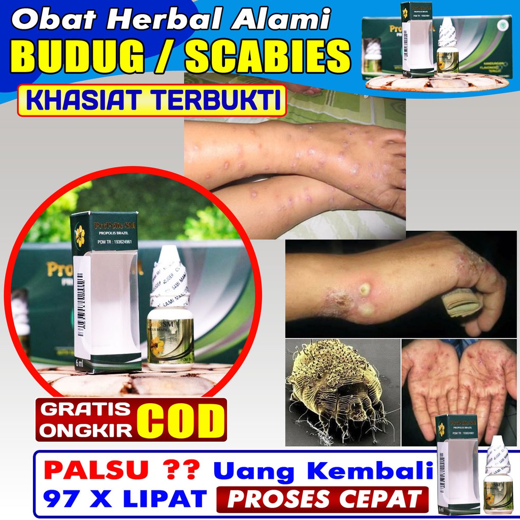 Jual Obat Herbal Budug Santri, Budugan Di Kaki, Buduk Di Tangan, Kepala ...