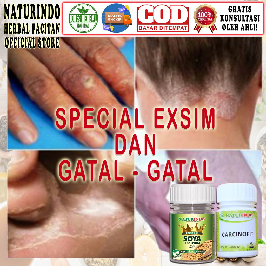 Jual Obat Gatal Kadas Kudis Kurap Eksim Herpes Kutu Air Gatal Pada ...