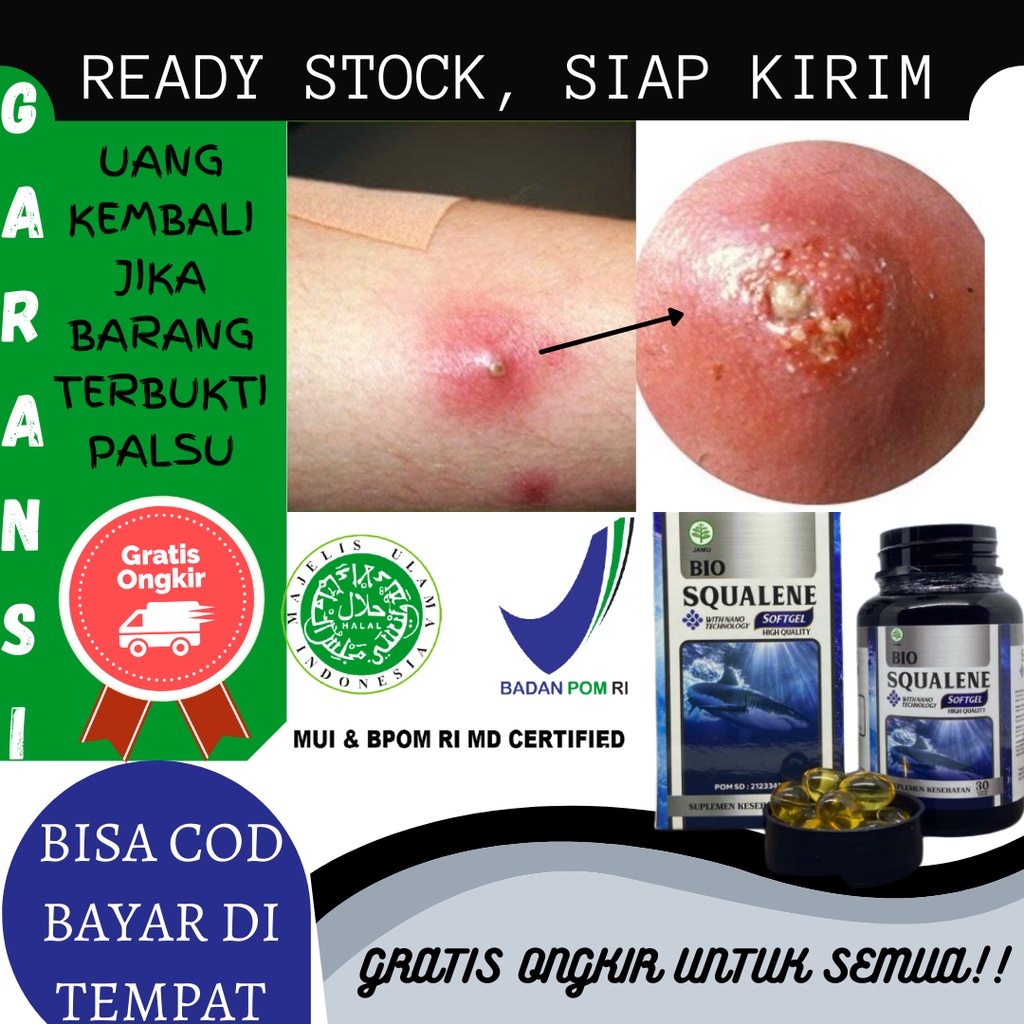 Jual Obat Penghilang Bisul, Lipoma, Benjolan Tiroid, Gondok / Gondongan ...