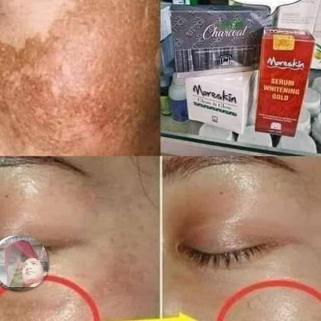 Jual Paket Flek Hitam Nasa | Shopee Indonesia