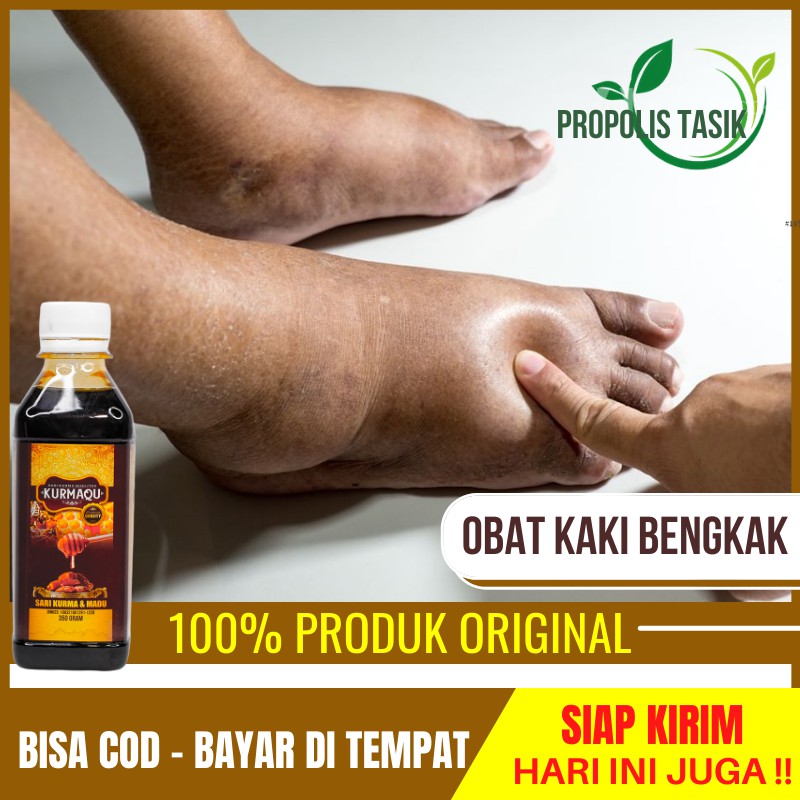 Jual Obat Kaki Bengkak, Sakit Tumit Kaki, Varises, Farises, Urat ...