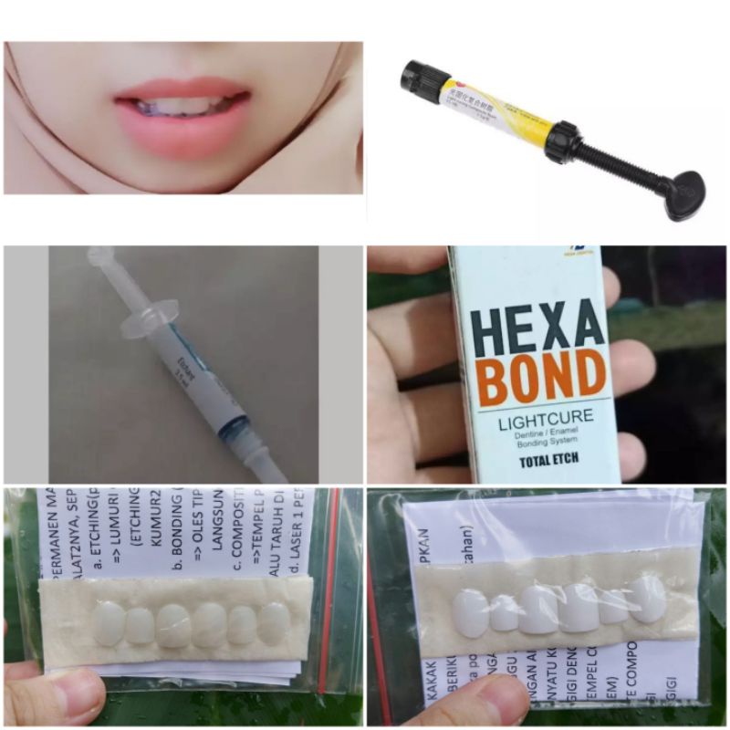 Jual paket lem gigi kelinci pemasangan di rumah | Shopee Indonesia