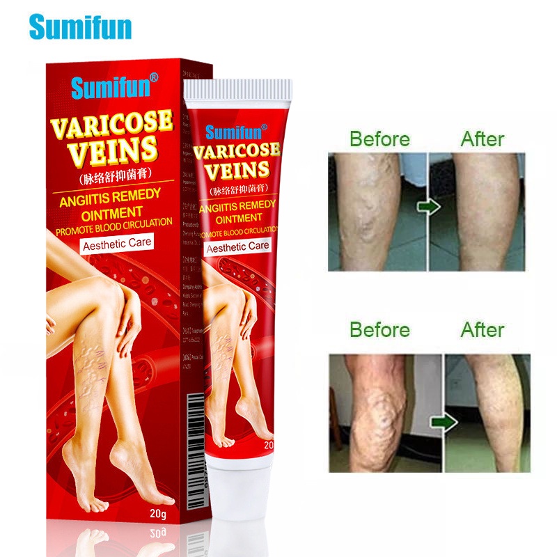 Jual Salep Varises Cream Varicose Veins Obat Varises Varikokel Bengkak ...