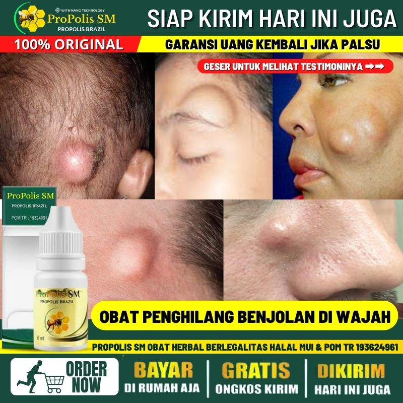 Jual Salep Penghilang Benjolan Abnormal di Wajah, Bisul Bernanah di ...