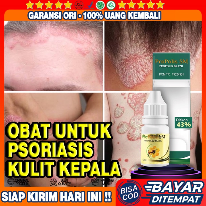 Jual Obat Psoriasis Kulit Kepala, Penyakit Kulit Psoriasis Di Kepala, Kepala Berkerak, Kepala ...