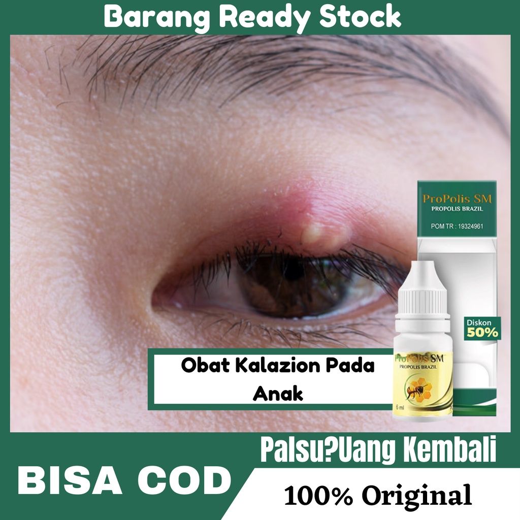 Jual Obat Kalazion Pada Anak , Benjolan Kecil Di Kelopak Mata Anak ...