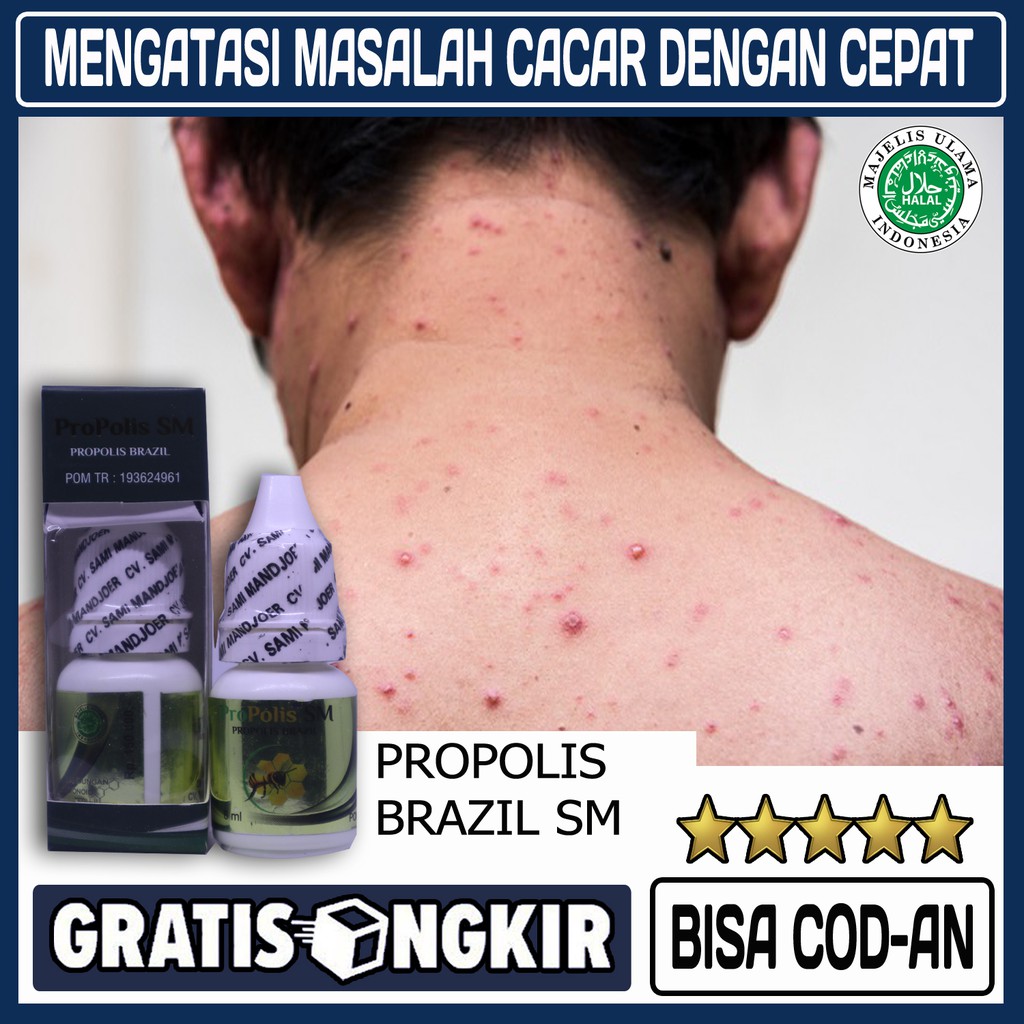 Jual Obat Cacar, Cacar Air, Cacar Bernanah, Cacar Ular, Herpes Genital ...