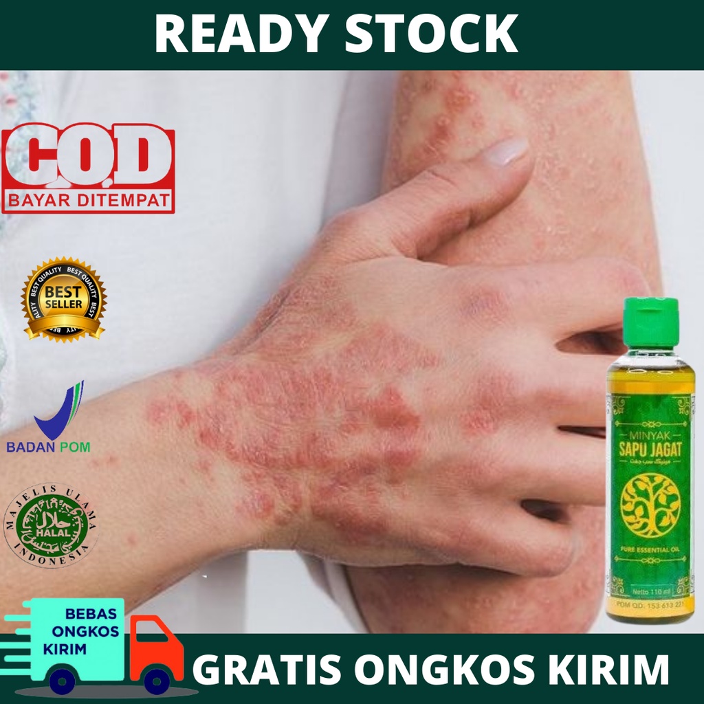 Jual Obat Scabies Manusia, Gatal Scabies, Obat Gangguan Kulit, Kulit ...