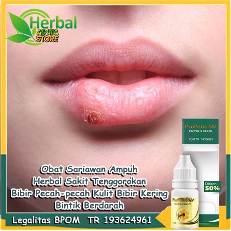 Jual Obat Sariawan, Herbal Sakit Tenggorokan, Bibir Pecah-pecah Kulit ...