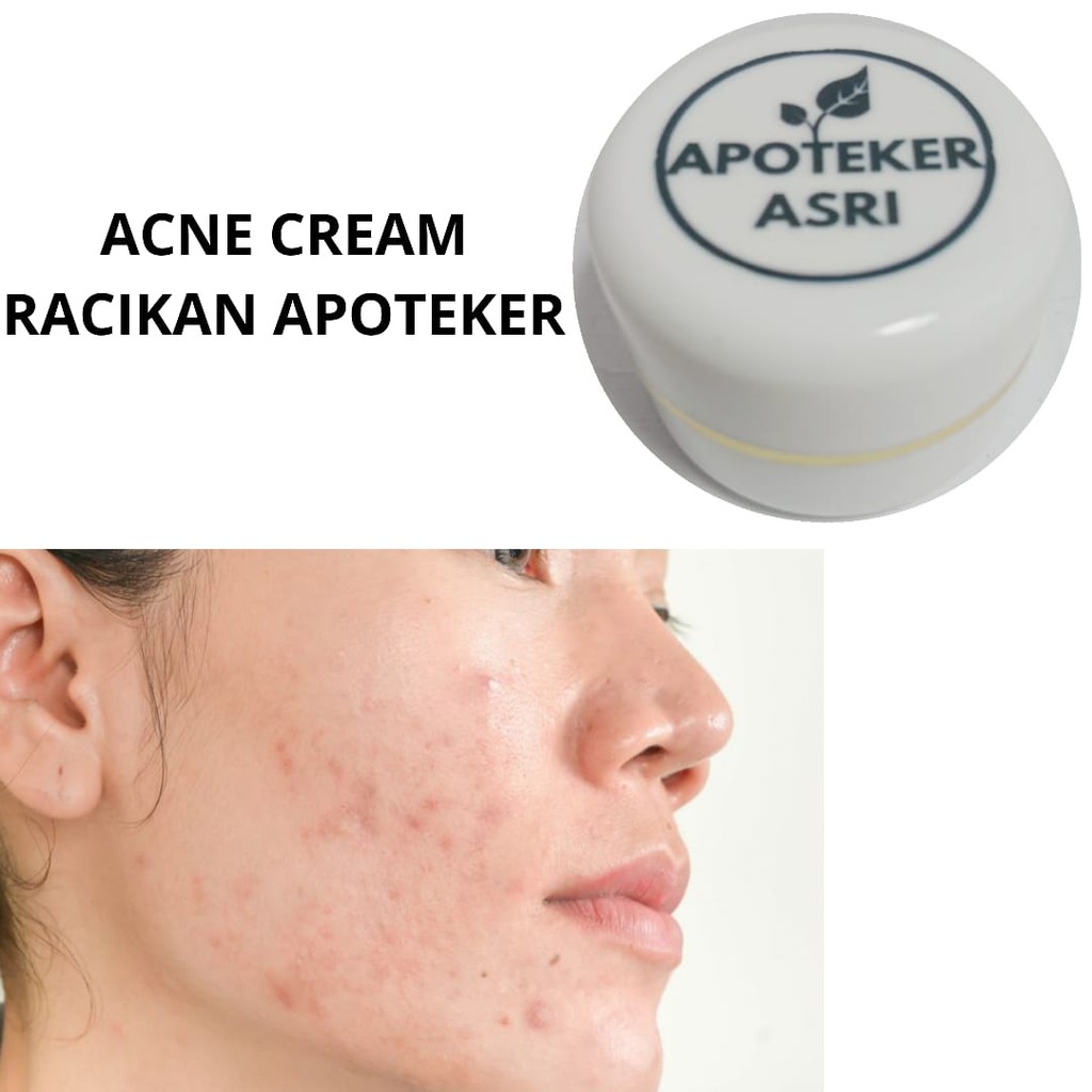 Jual Krim Acne Cream Clindamycin - Obat Jerawat Bruntusan Radang ...