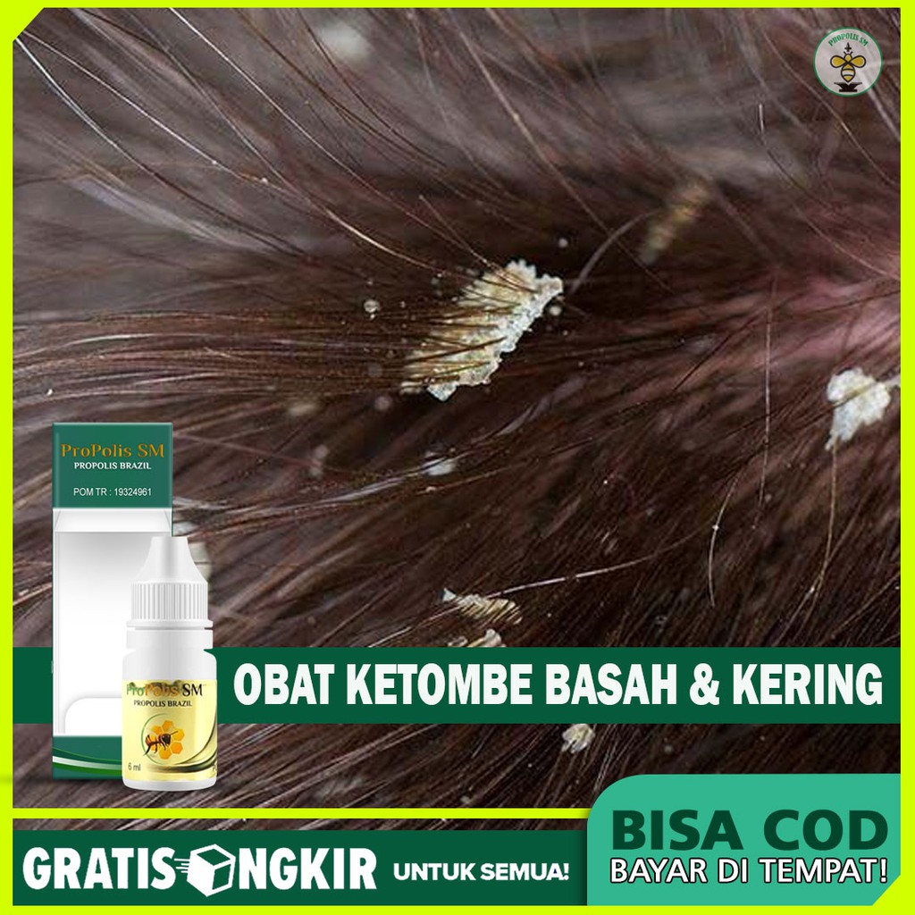 Jual OBAT KETOMBE BERKERAK - OBAT KETOMBE BASAH / KERING - OBAT KETOMBE BERSISIK PARAH ...