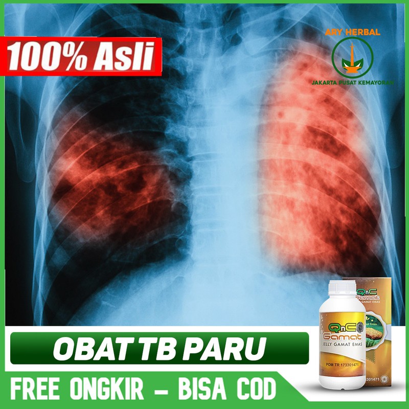 Jual Obat Tb Paru, Tbc Anak, Usus, Payudara, Kelenjar, Tulang Herbal ...