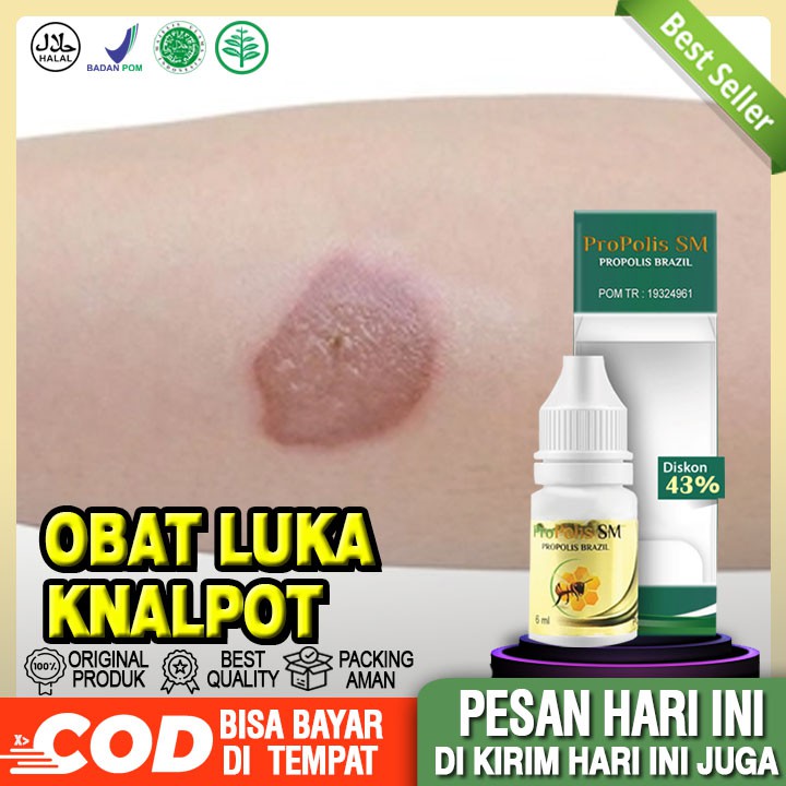 Jual Obat Untuk Luka Knalpot, Obat Luka Akibat Terkena Kenalpot, Obat ...