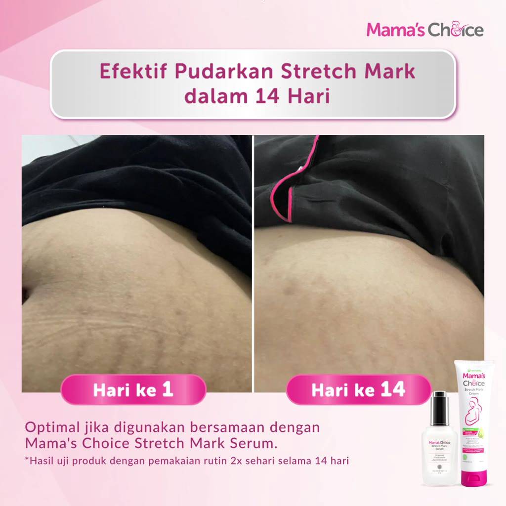 Jual Mama's Choice Stretch Mark Cream (Krim Penghilang Strechmark Aman ...