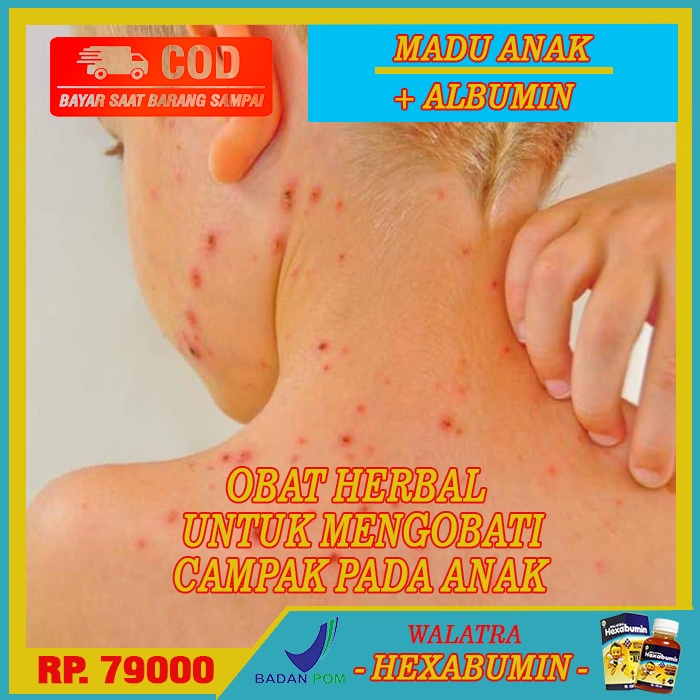 Jual Obat Campak Pada Anak, Obat Campak Tampek Rubella Pada Anak, Obat ...