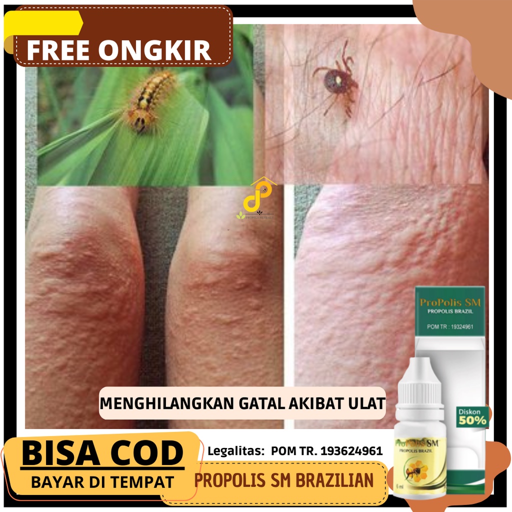 Jual Cara Menghilangkan Gatal Akibat Ulat Bulu - PSM Obat anti Alergi ...