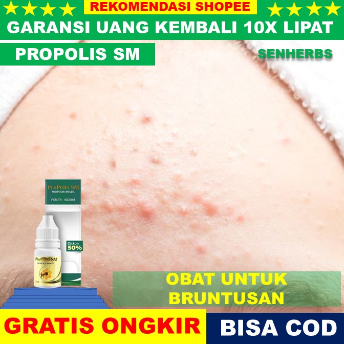 Jual Obat bruntusan, obat bruntusan wajah, obat beruntusan wajah, cream ...
